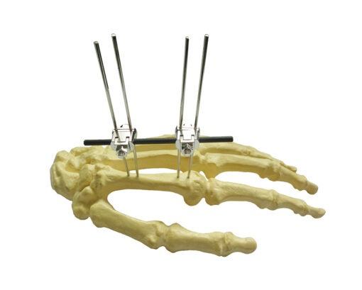 Système modulaire de fixateur externe