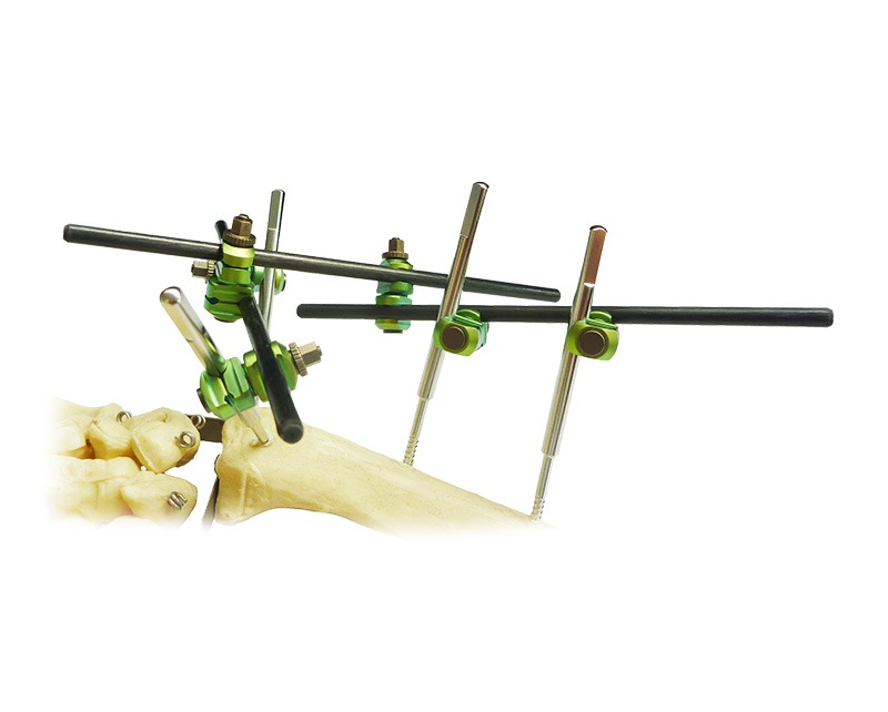 Modular External Fixator System